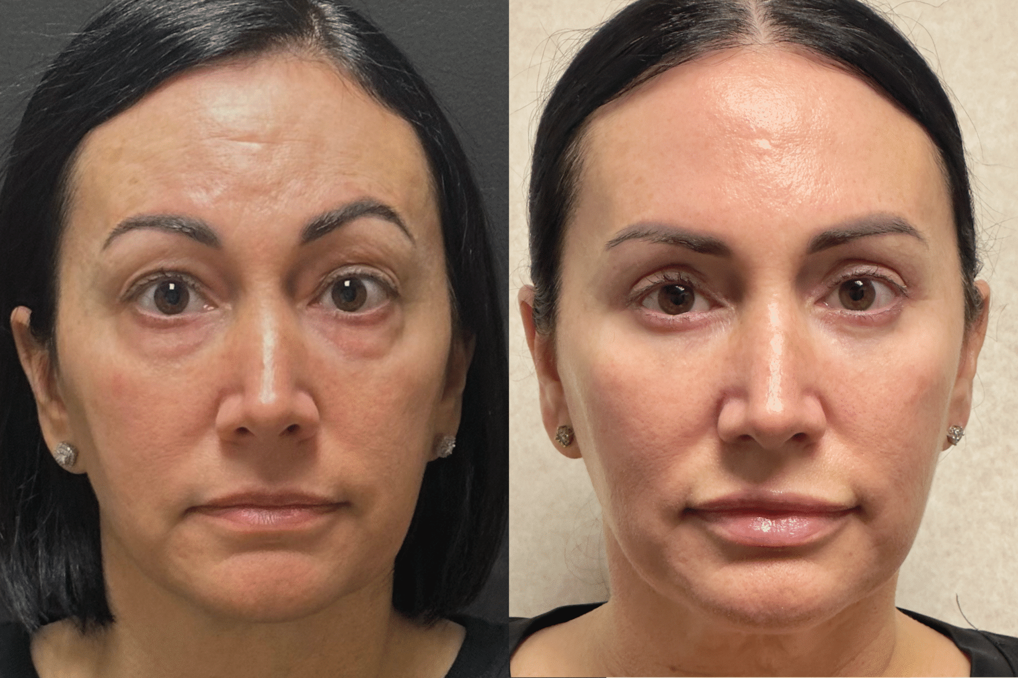 Upper & Lower Eyelid Lift - Bella Cosmetic Surgery